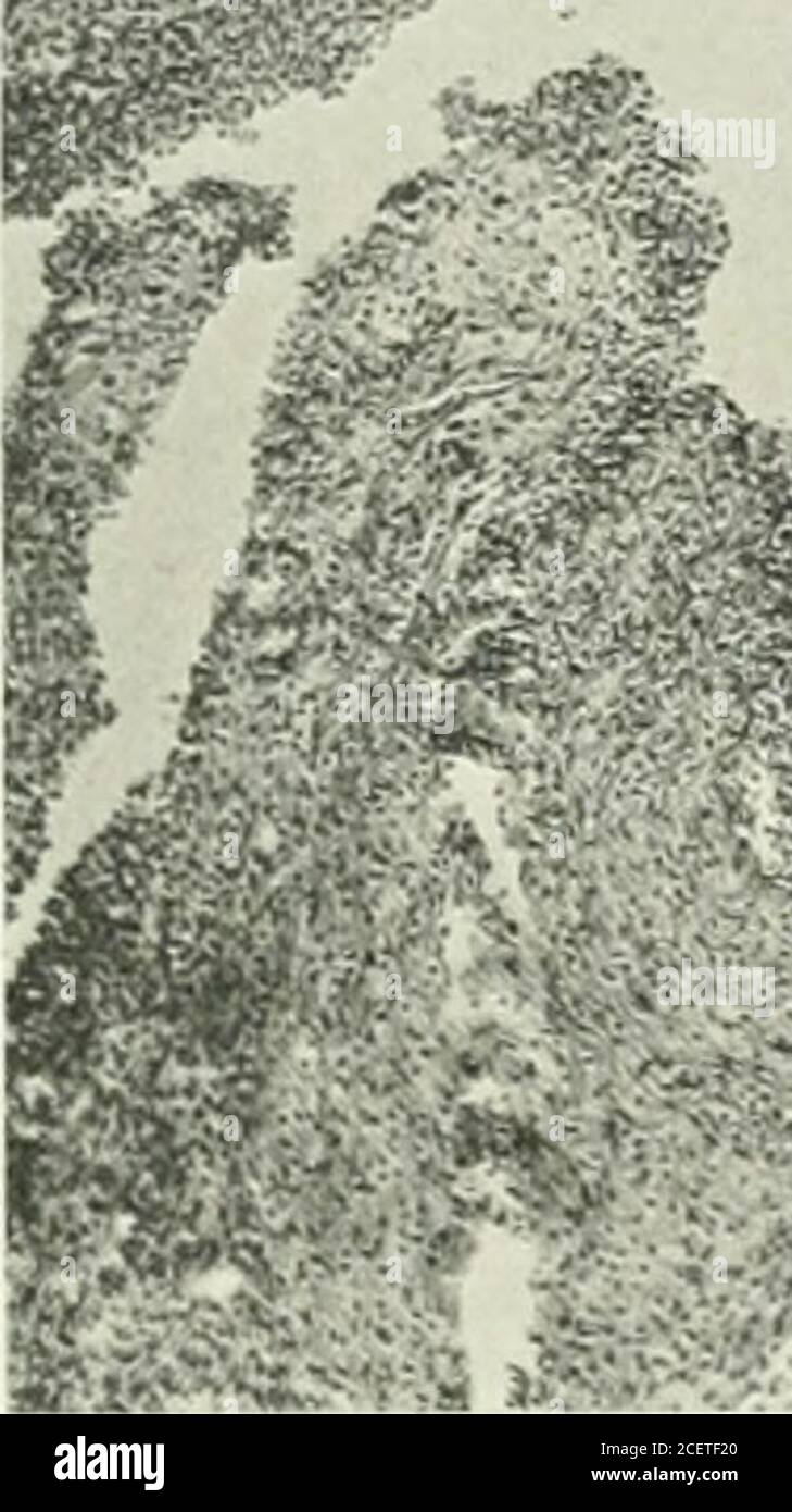 Granuloma inguinale hi-res stock photography and images - Alamy