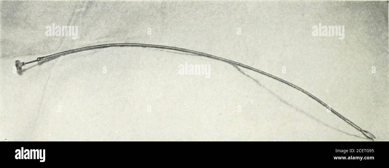 . Annals of surgery. Button for lateral anastomos Button for end-to ...