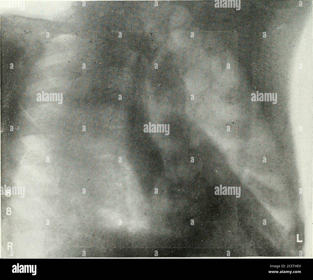 . Annals of surgery. Interior of the cavity as it appears after ...