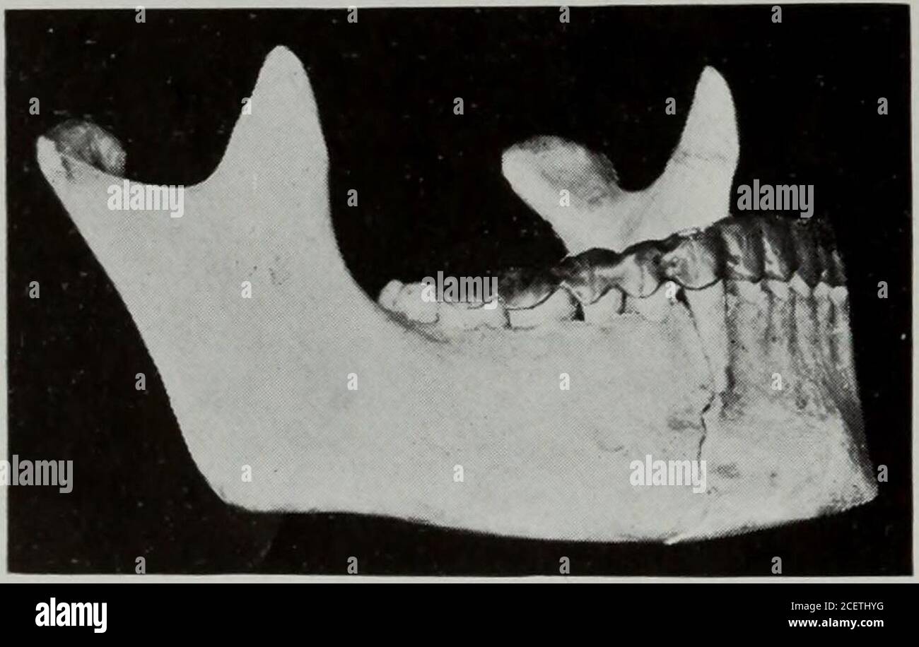 Mandibular fracture hi-res stock photography and images - Alamy