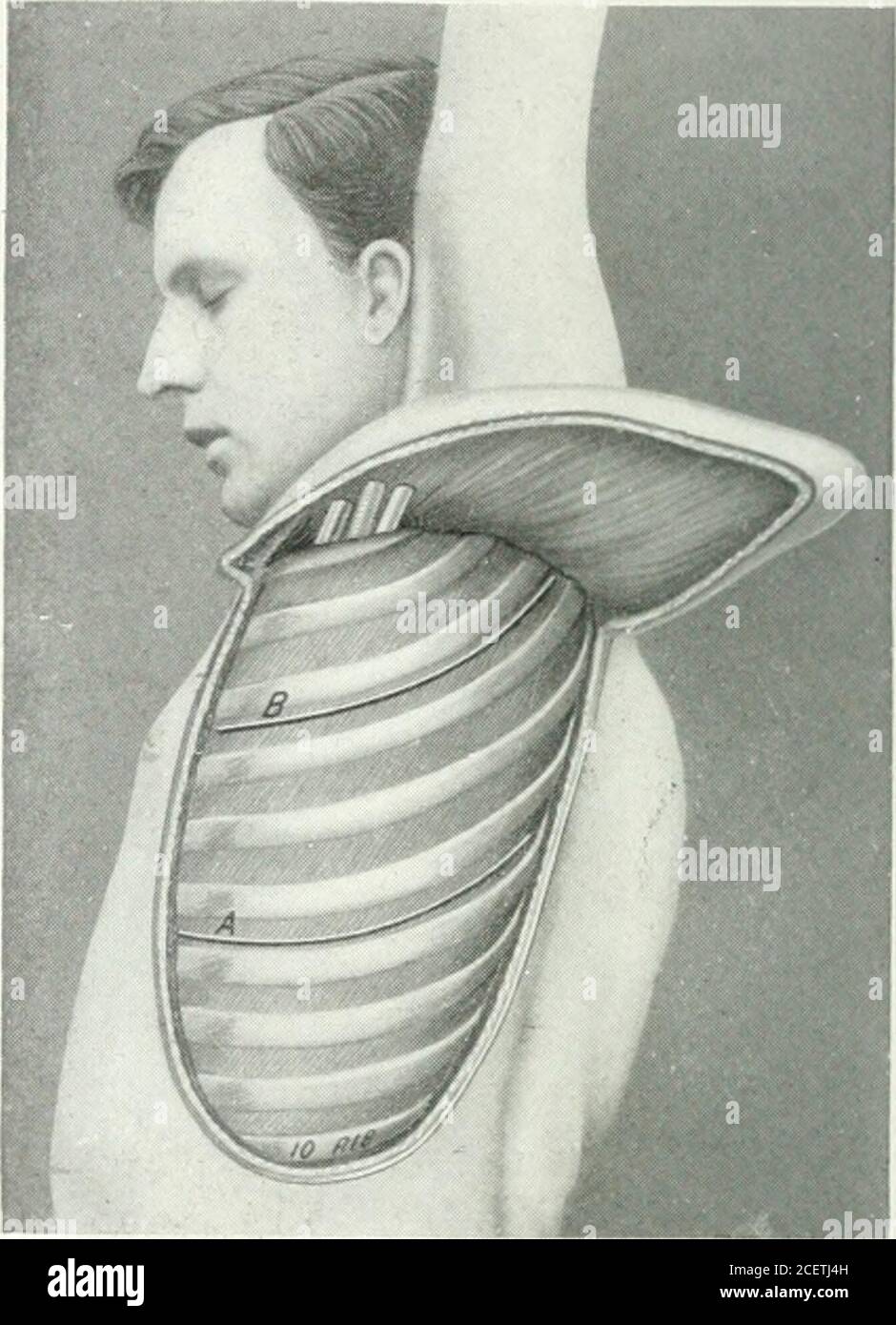 . Annals of surgery. Fig. 2.—Schedes incision for raising a skin muscle ...