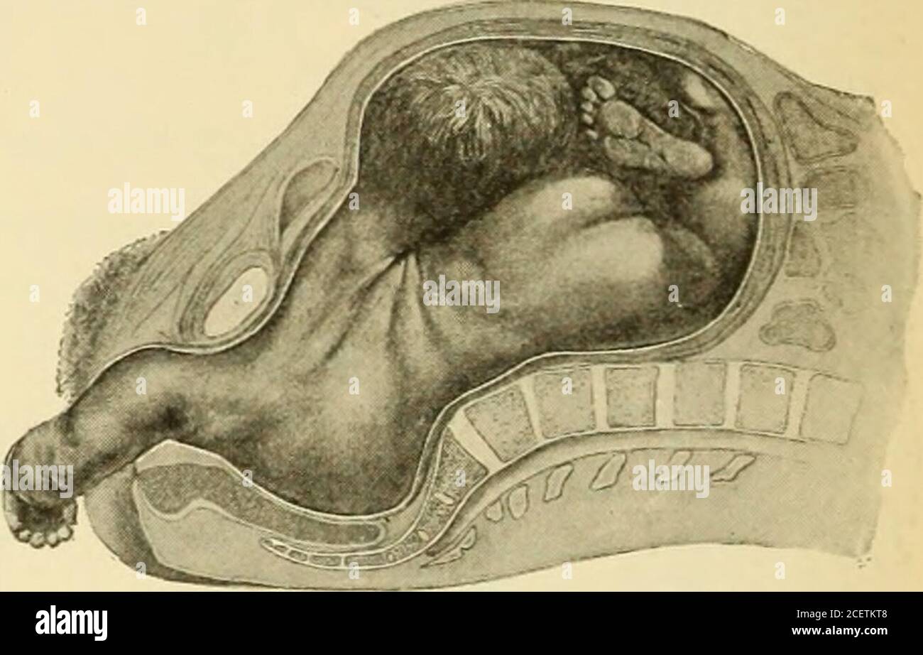. An American text-book of obstetrics. For practitioners and students ...