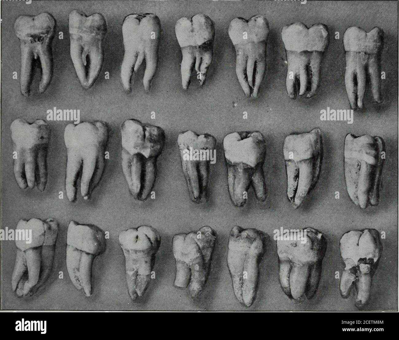 Supernumerary teeth hi-res stock photography and images - Alamy