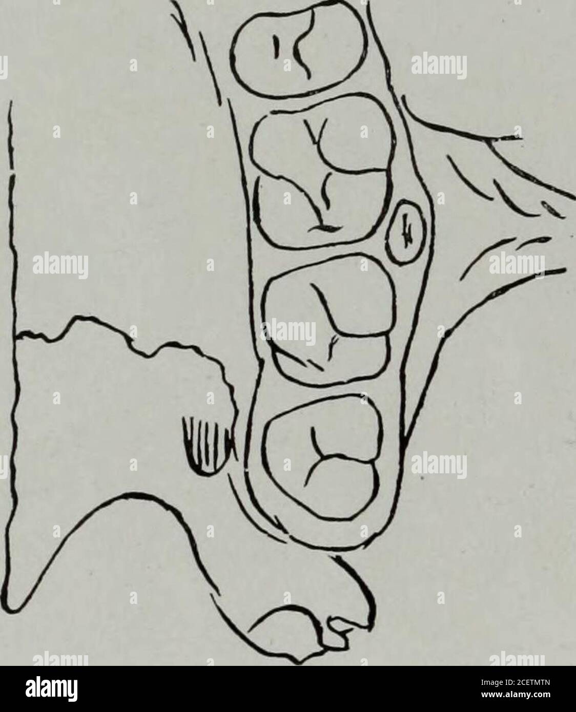 Fourth molar hi-res stock photography and images - Alamy