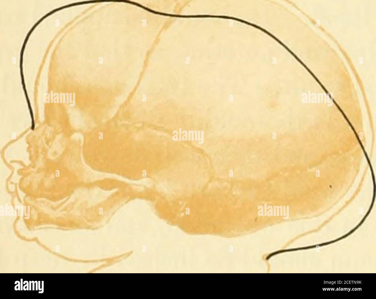 Brow Presentation Diameter