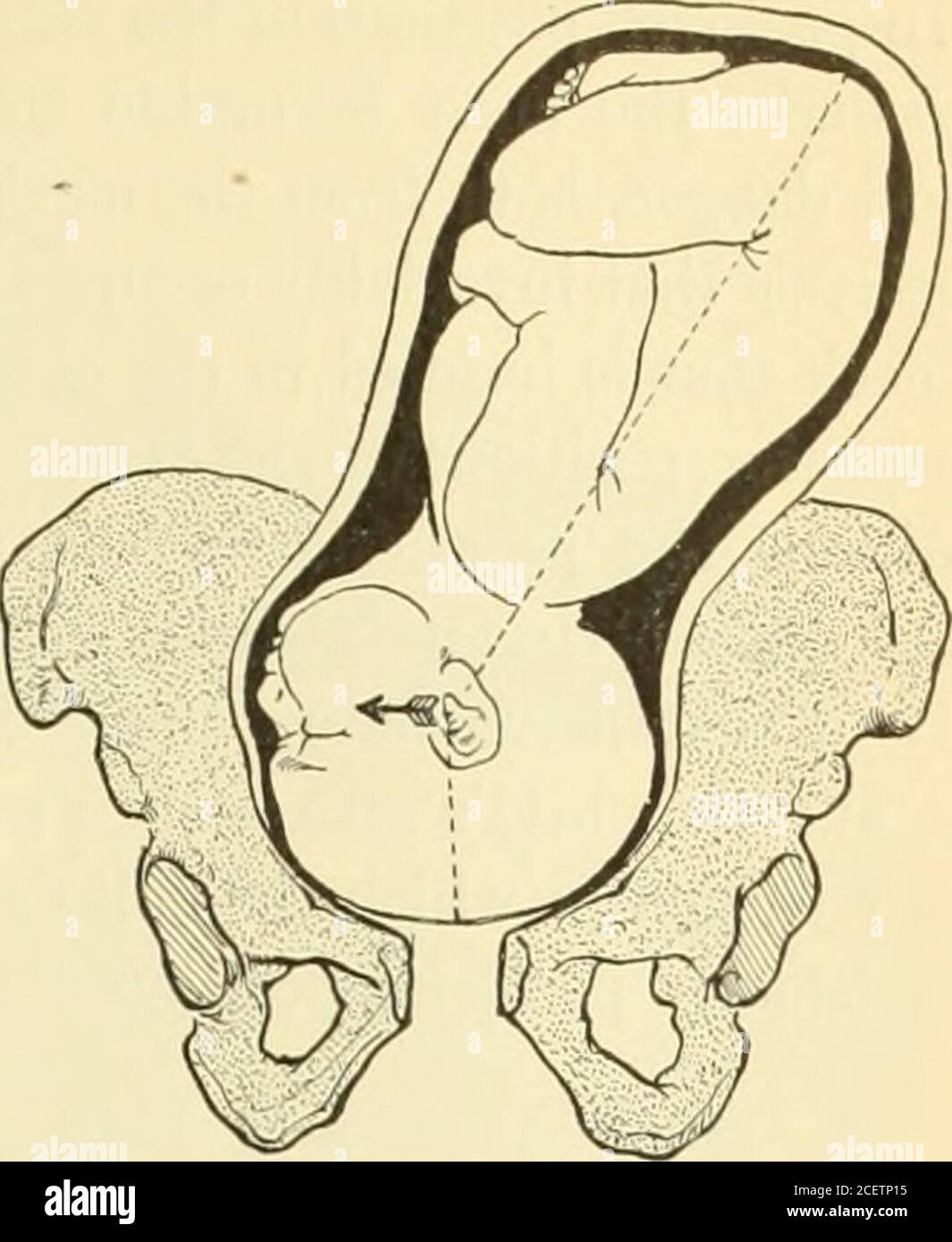 Cephalic presentation hi-res stock photography and images - Alamy