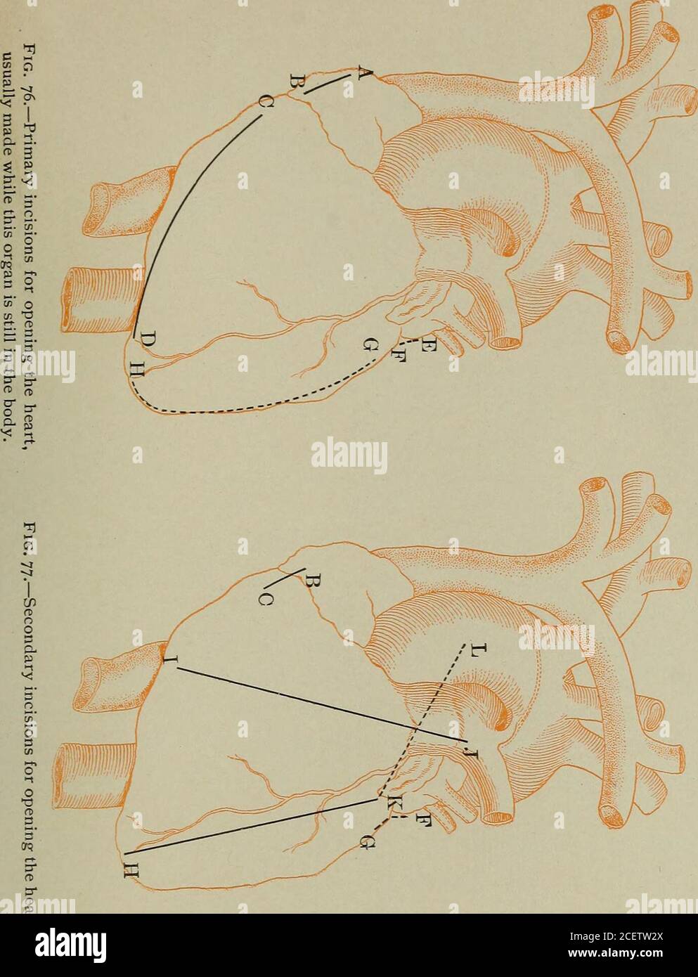 Ventricular septum right ventricle hi-res stock photography and images ...