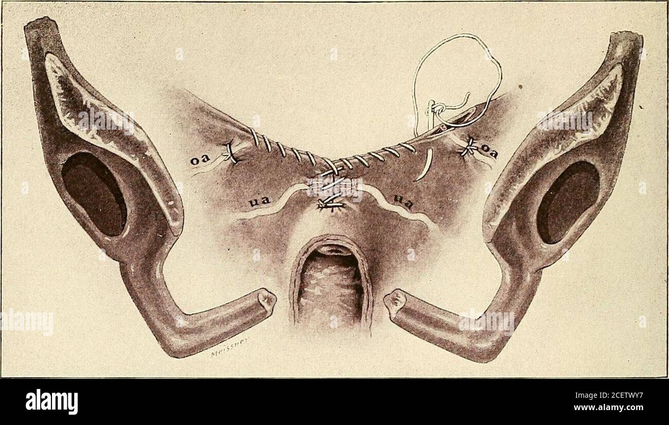Ovarian Ligaments High Resolution Stock Photography and Images - Alamy
