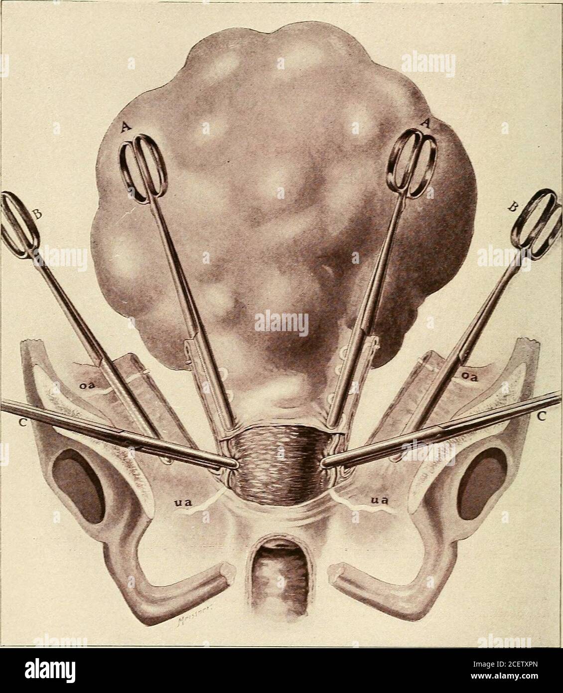 Ovarian ligaments hi-res stock photography and images - Alamy