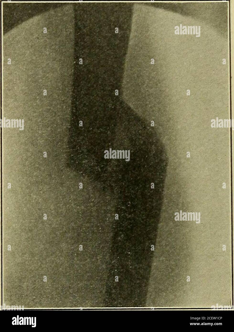 Lateral traction hi-res stock photography and images - Alamy