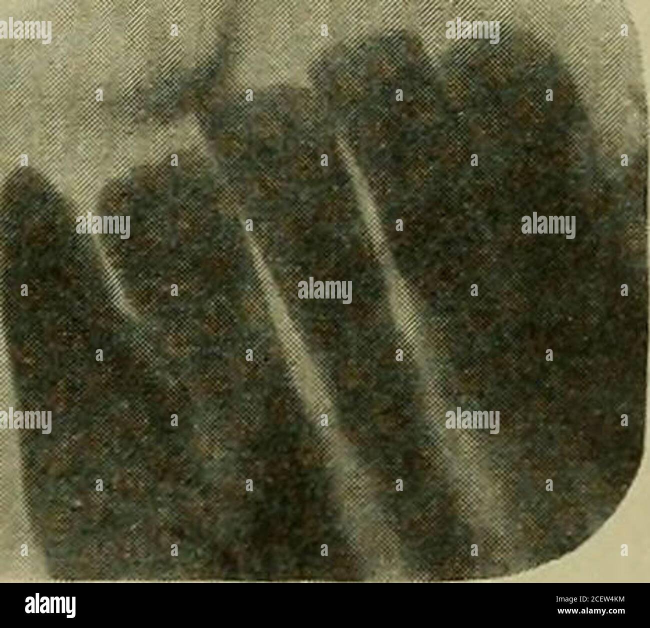 . Medical and surgical report. Fig. 15.—Chronic abscess; lateral root ...