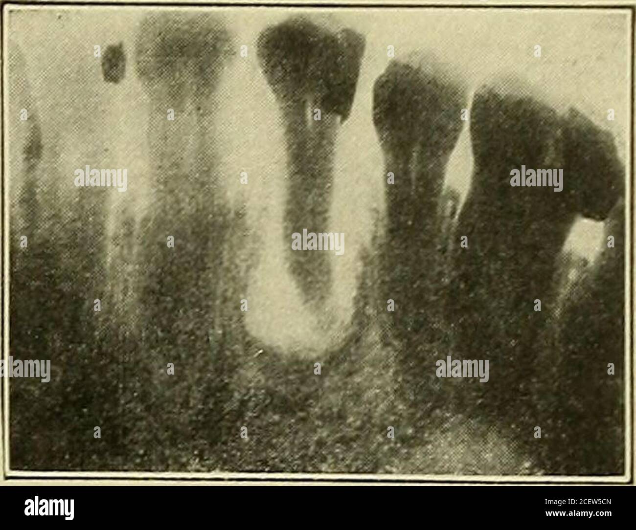 . Medical and surgical report. Fig. 11.—Advanced abscess; no signs or ...