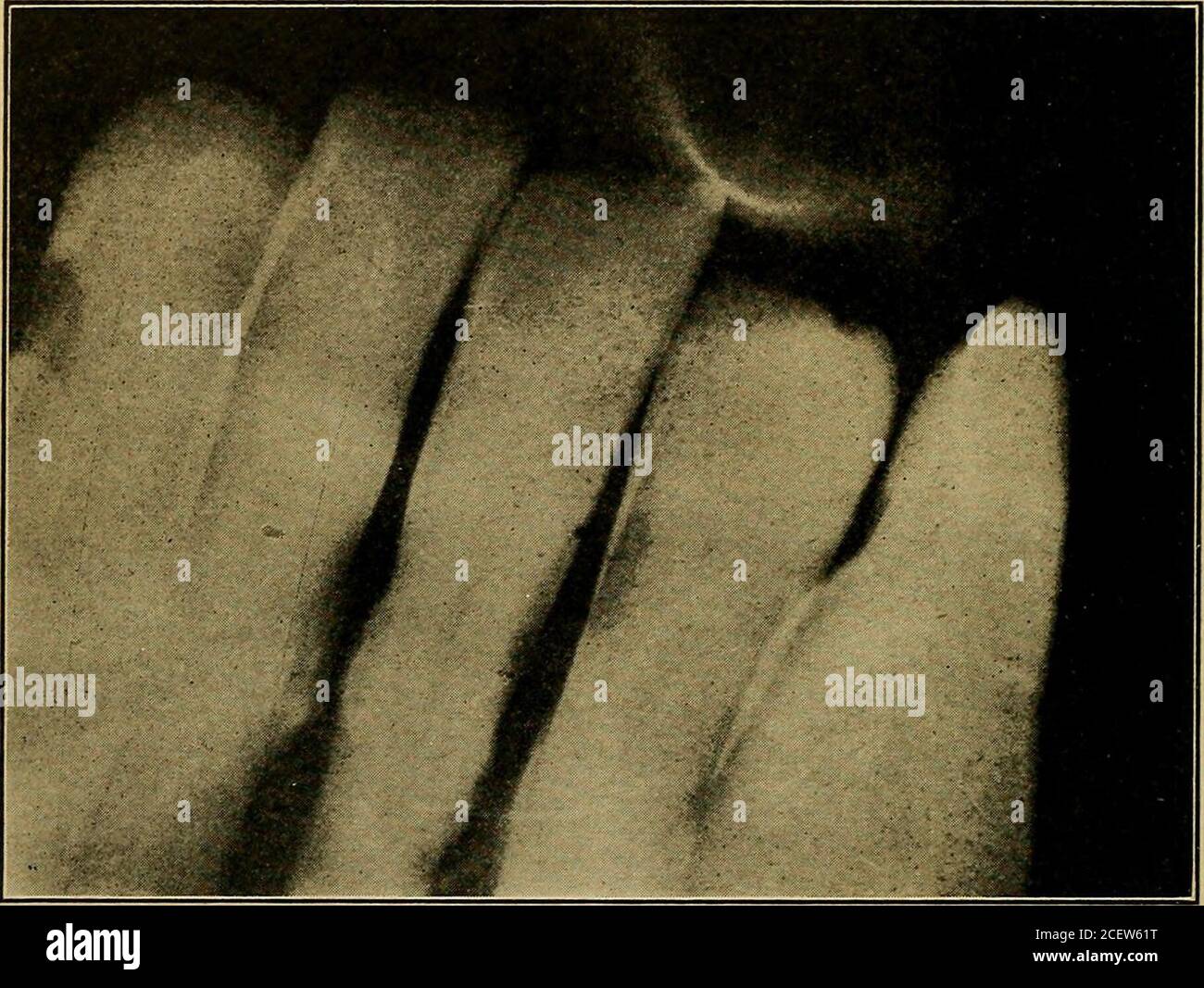 . Medical and surgical report. Fig. 9.—Chronic abscess; tooth structure ...