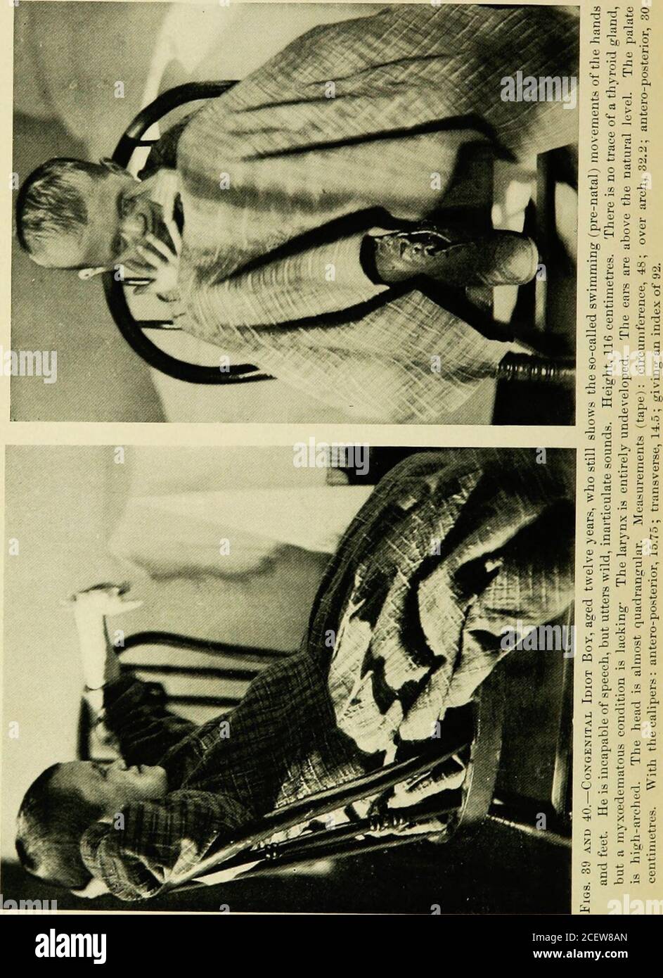 . A treatise on mental diseases. the microcephalic idiot. Other idiotic ...