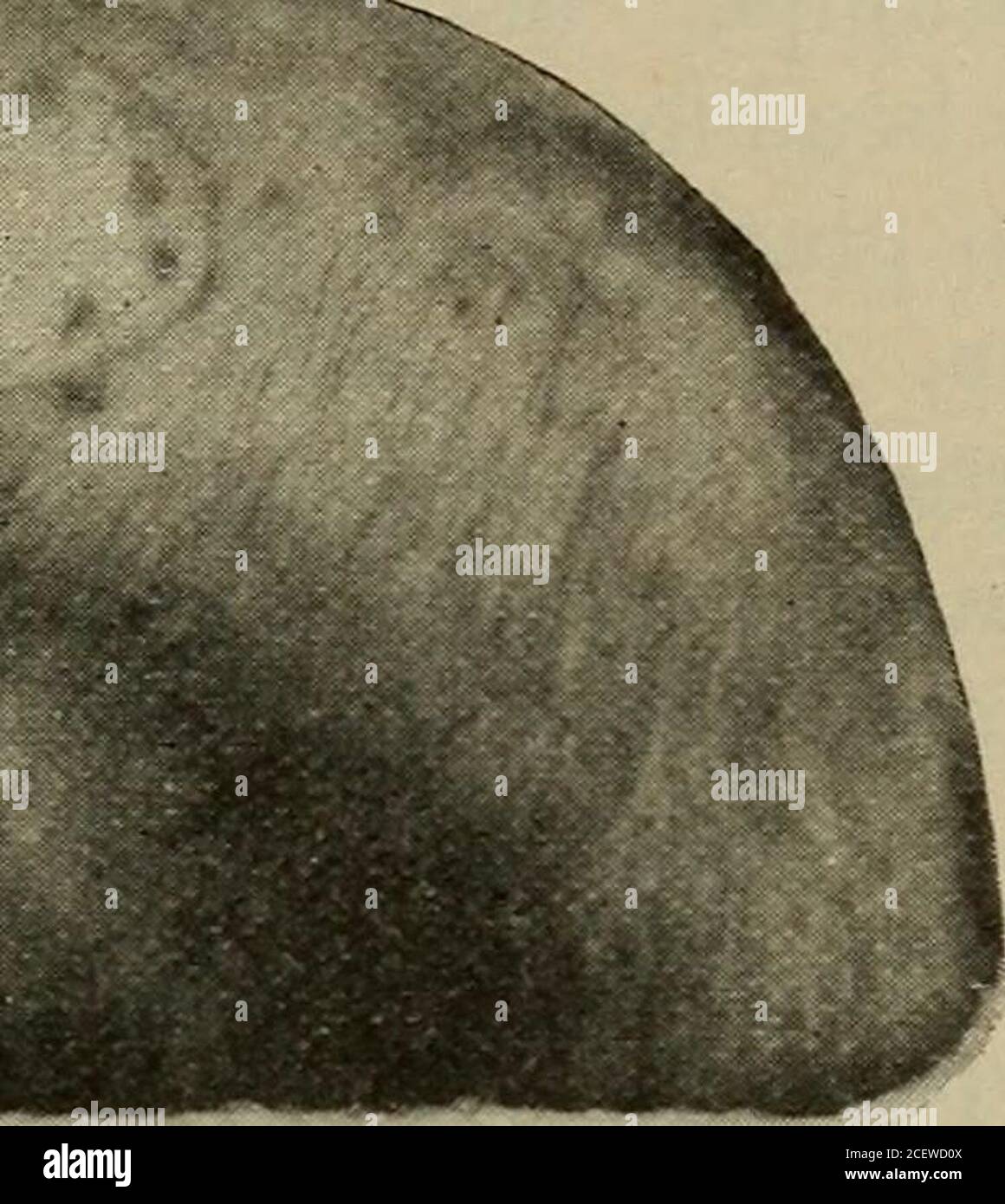 Tinea skin condition ringworm hi-res stock photography and images - Alamy