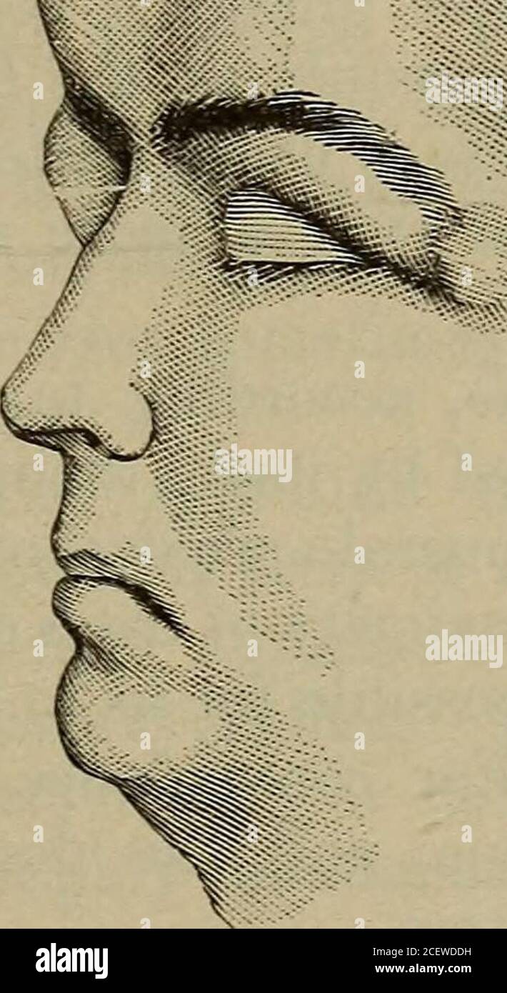 Subcutaneous nodule hi-res stock photography and images - Alamy