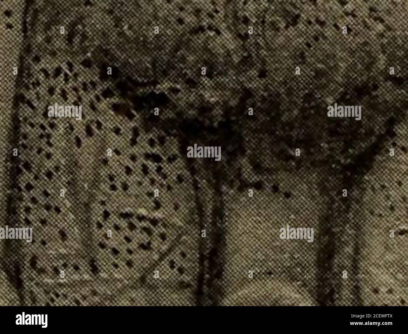 Psoriasis sur hi-res stock photography and images - Alamy