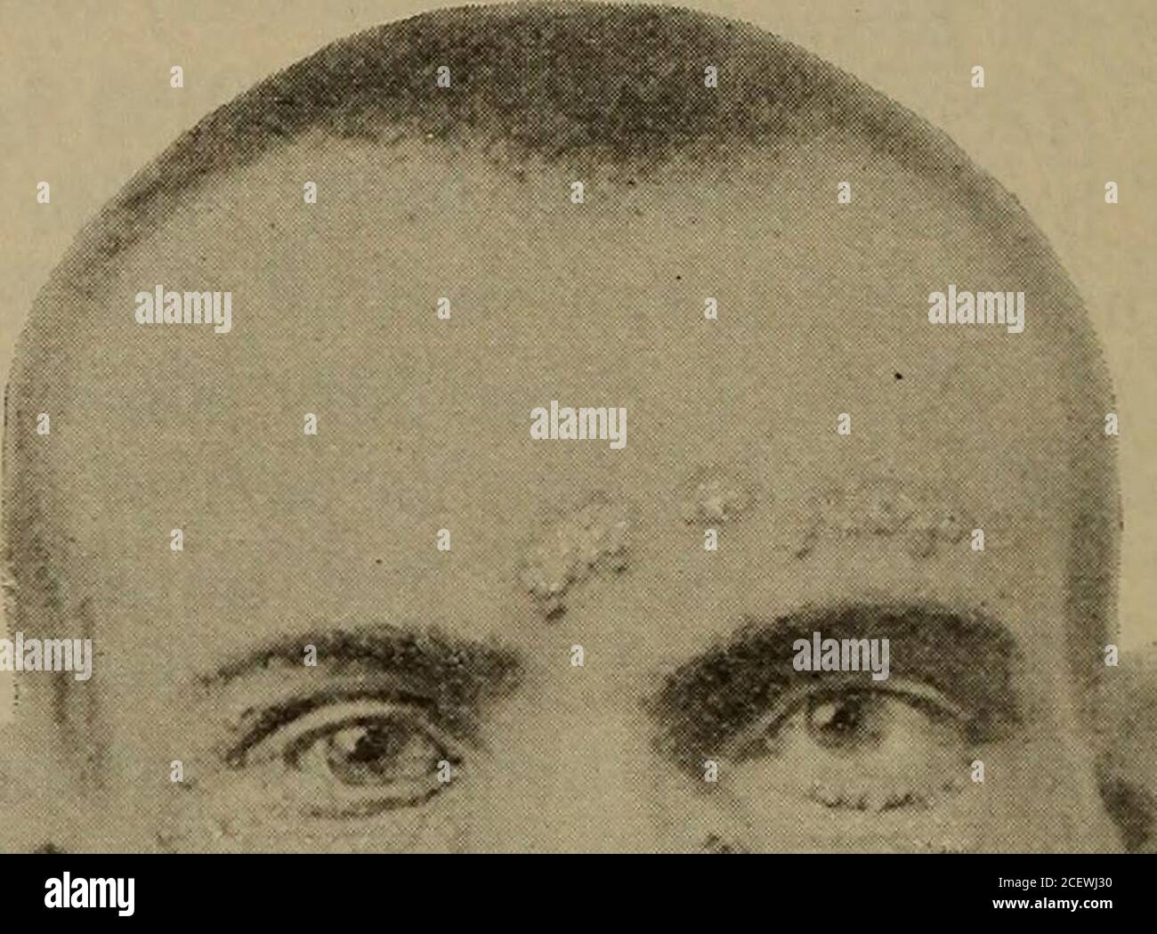 Lip vesicles hi-res stock photography and images - Alamy