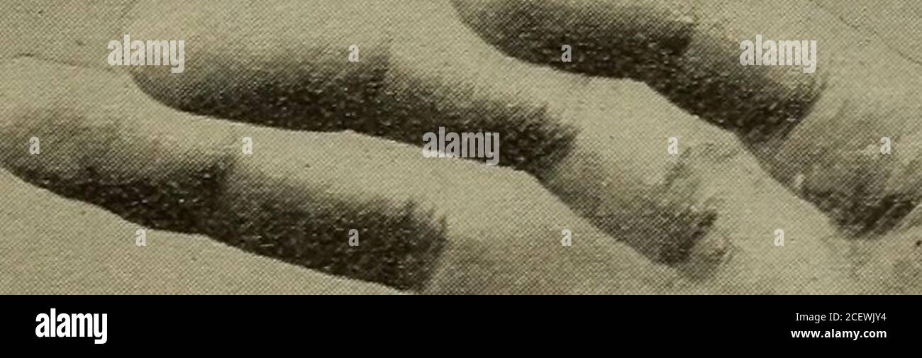 . The ready-reference handbook of diseases of the skin. Case of favus ...