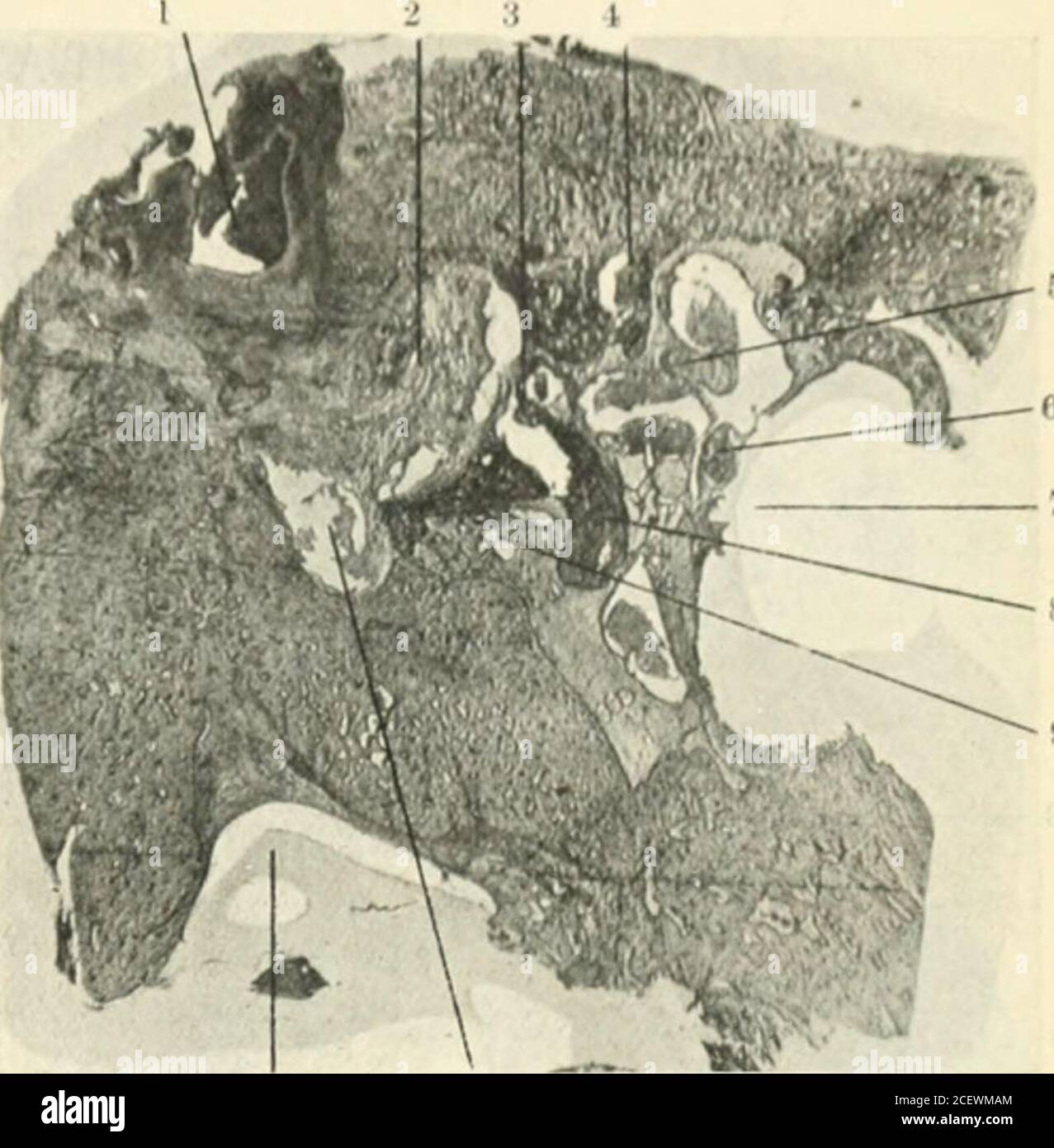 Ear canal abscess hi-res stock photography and images - Alamy