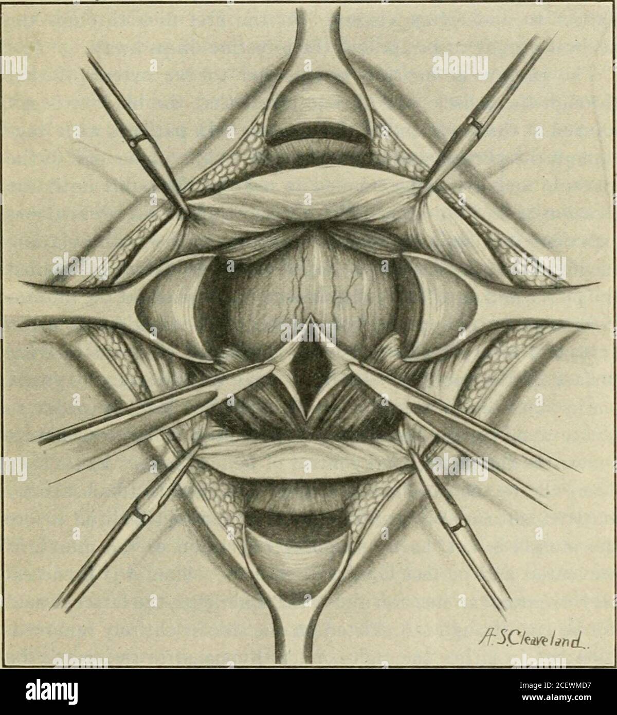 Deep abdominal fascia hi-res stock photography and images - Alamy