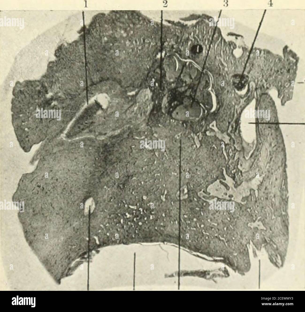 . The Journal of laryngology and otology. Fig. 1a.—Diseased left ear ...