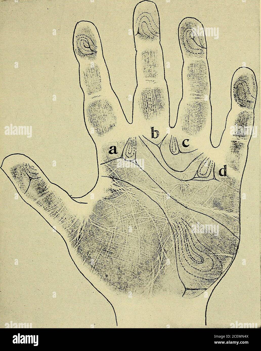 Right Hand Skin Diagram Sketch Silhouette Skin Color Left Arm With