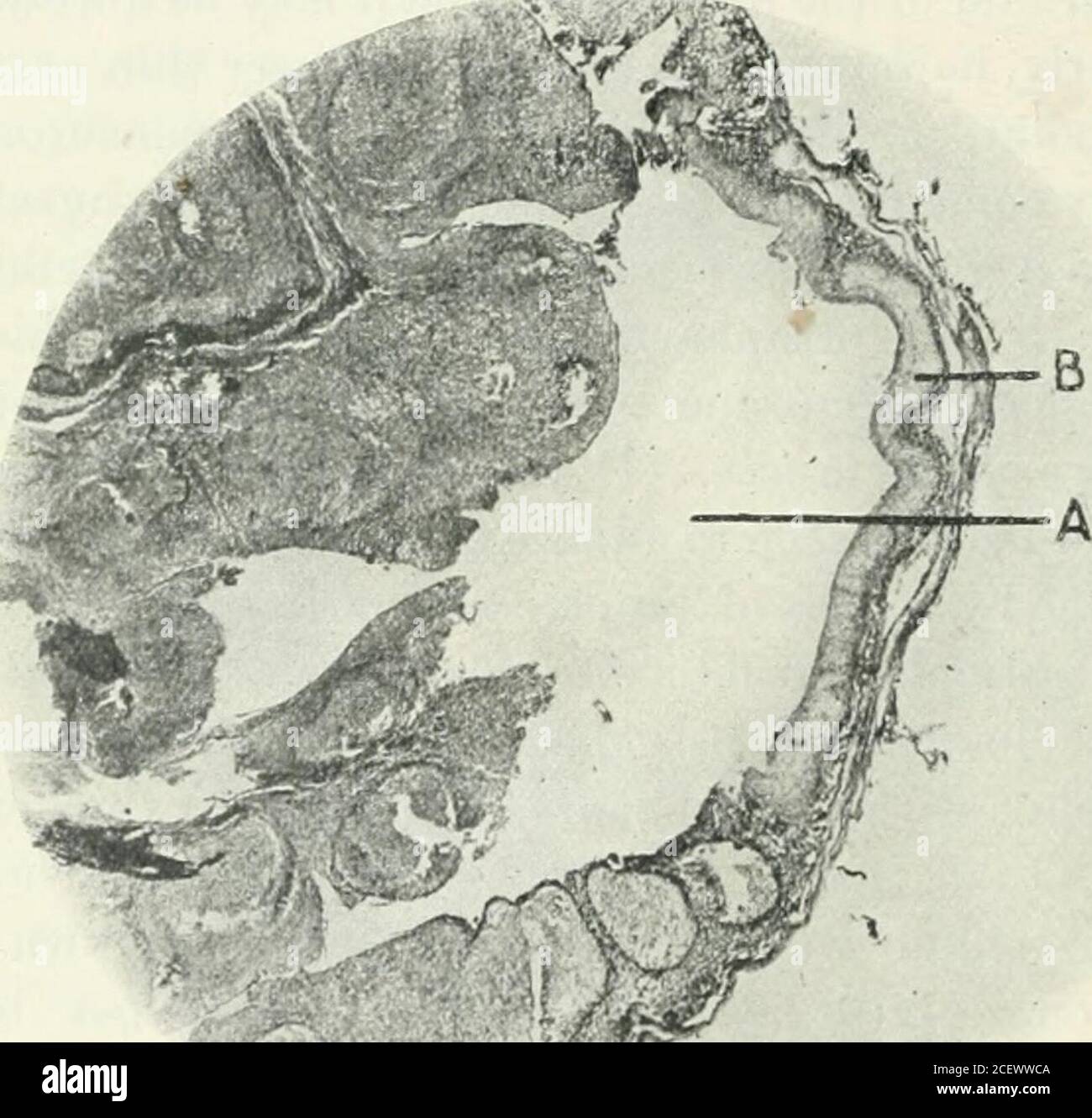 Tonsillar fossa hi-res stock photography and images - Alamy