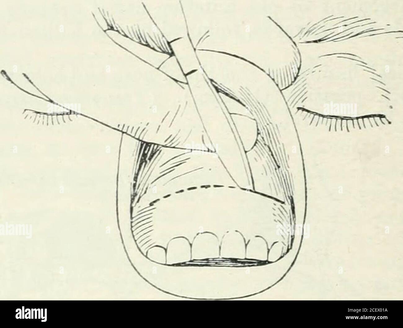 . The Journal of laryngology and otology. ) Sublabial oral incision (a ...