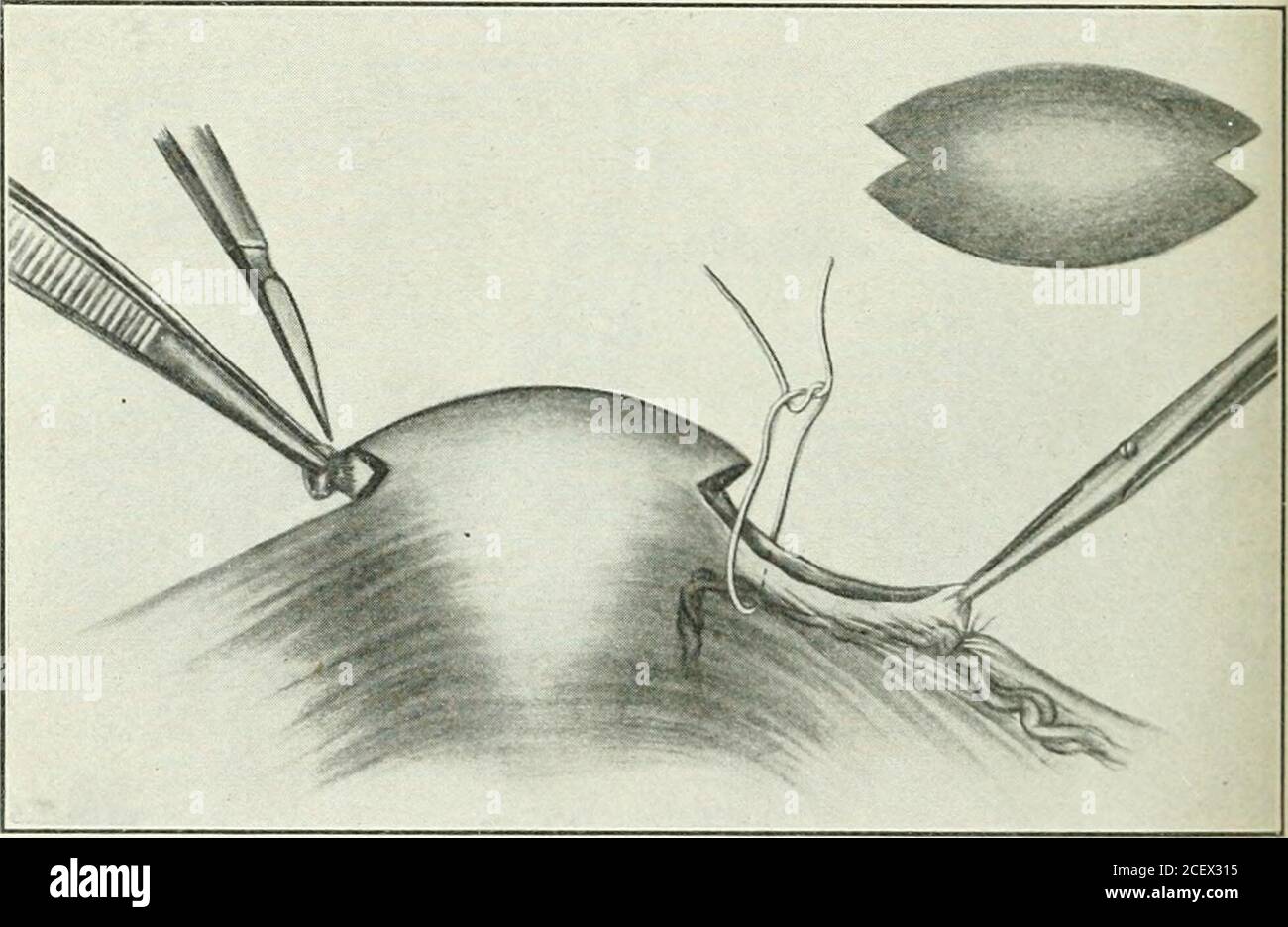 Double ligation hi-res stock photography and images - Alamy