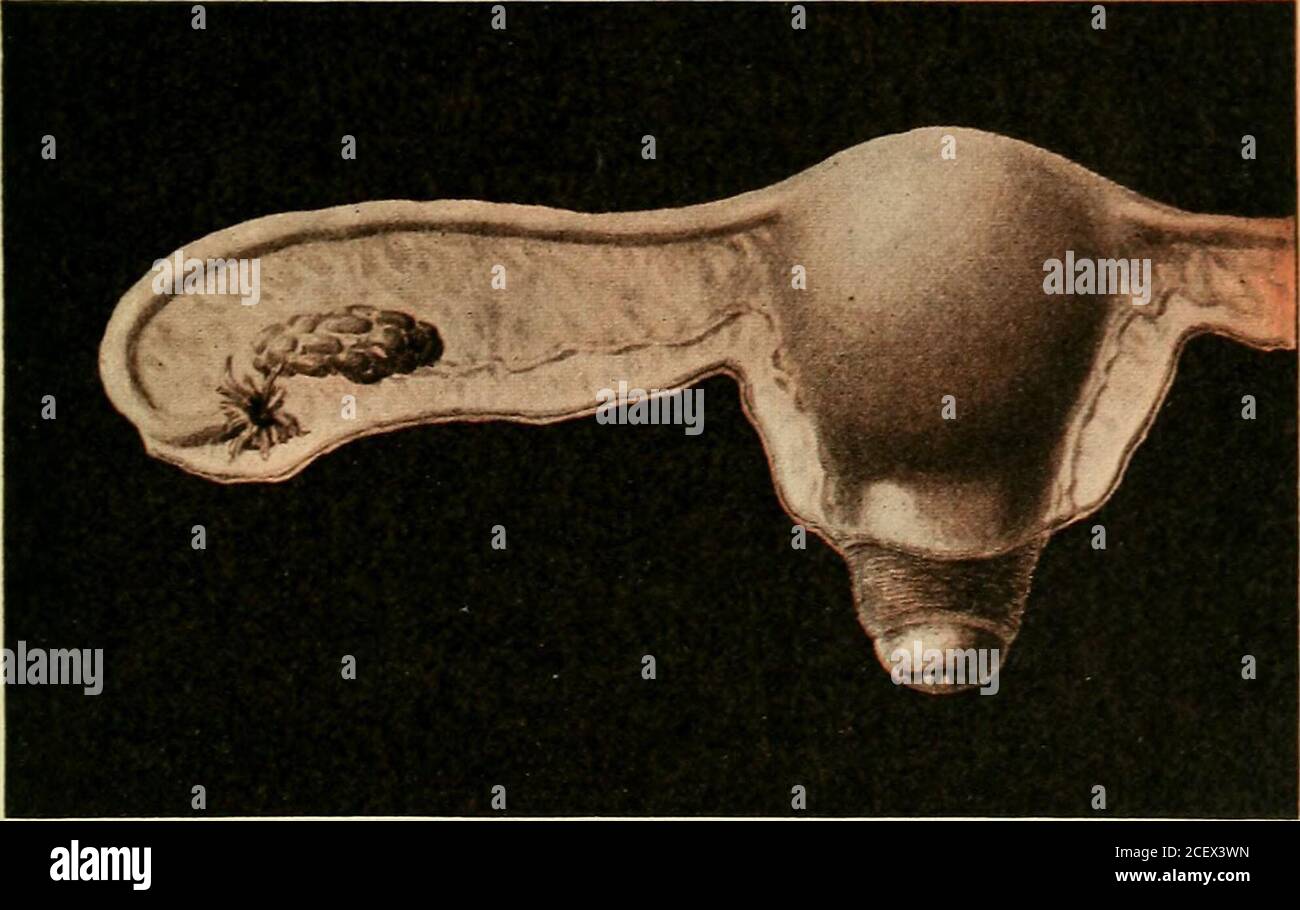 Pyelitis hi-res stock photography and images - Alamy