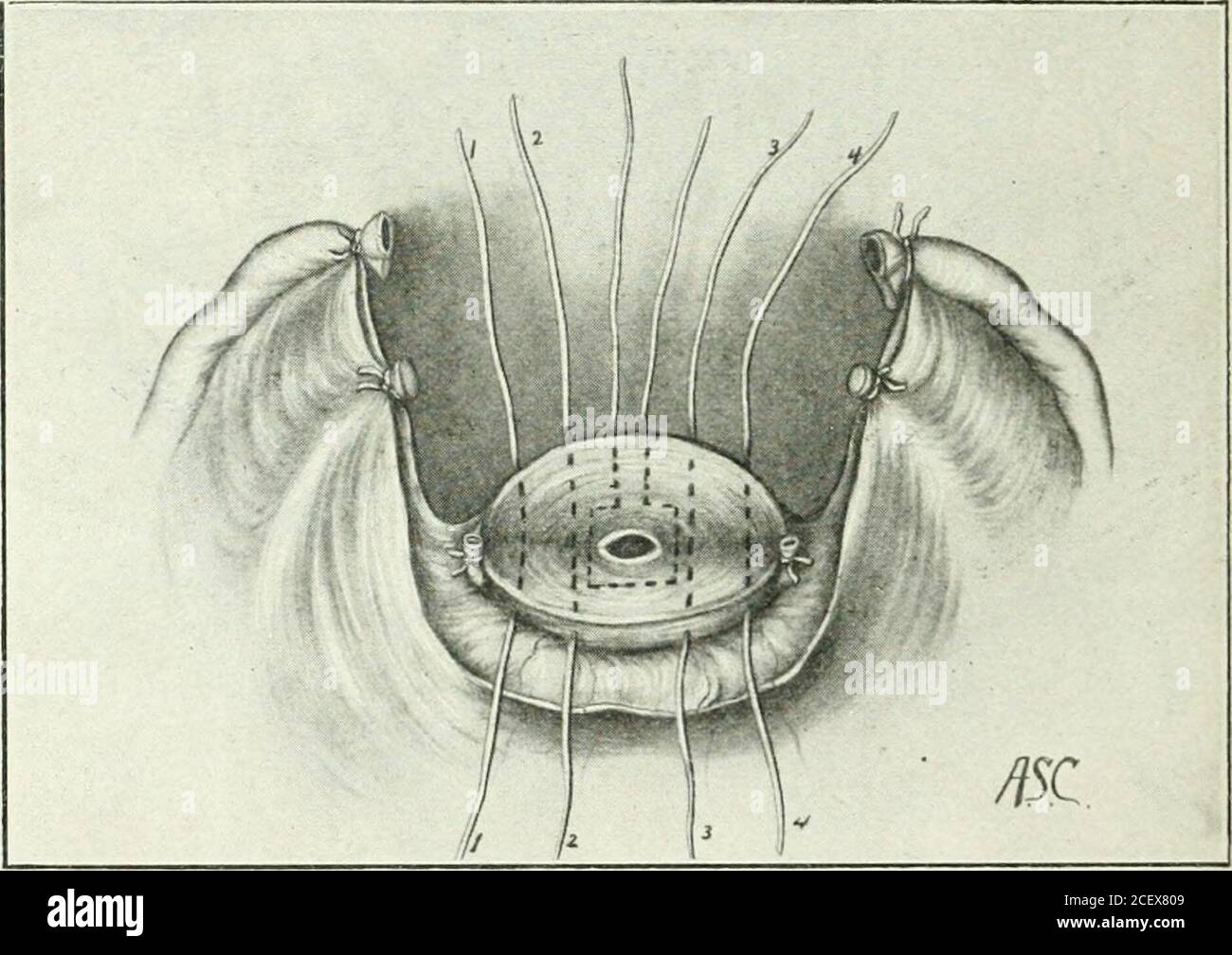 Cervical Stitch High Resolution Stock Photography and Images - Alamy