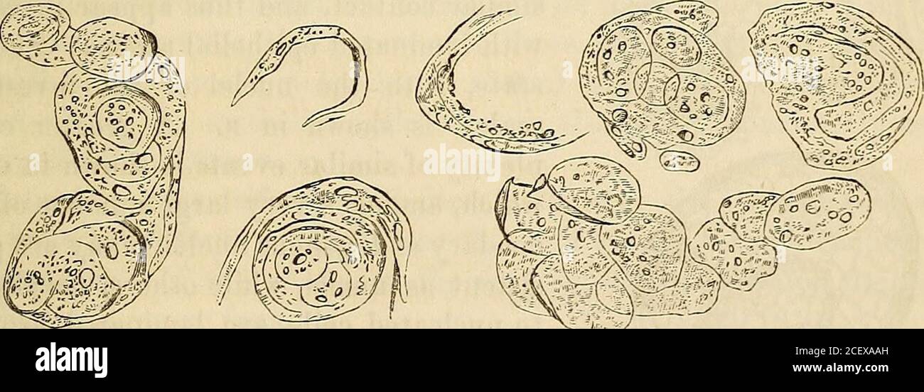 Sebaceous cyst hi-res stock photography and images - Alamy