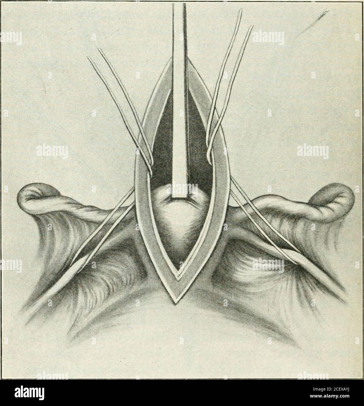 Pessary pelvic hi-res stock photography and images - Alamy