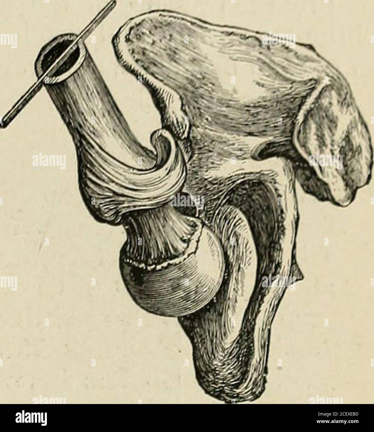 . A practical treatise on fractures and dislocations. Obturator ...