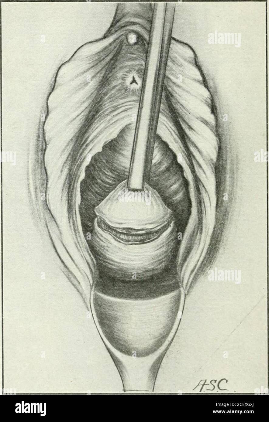 . A manual of gynæcology and pelvic surgery, for students and ...