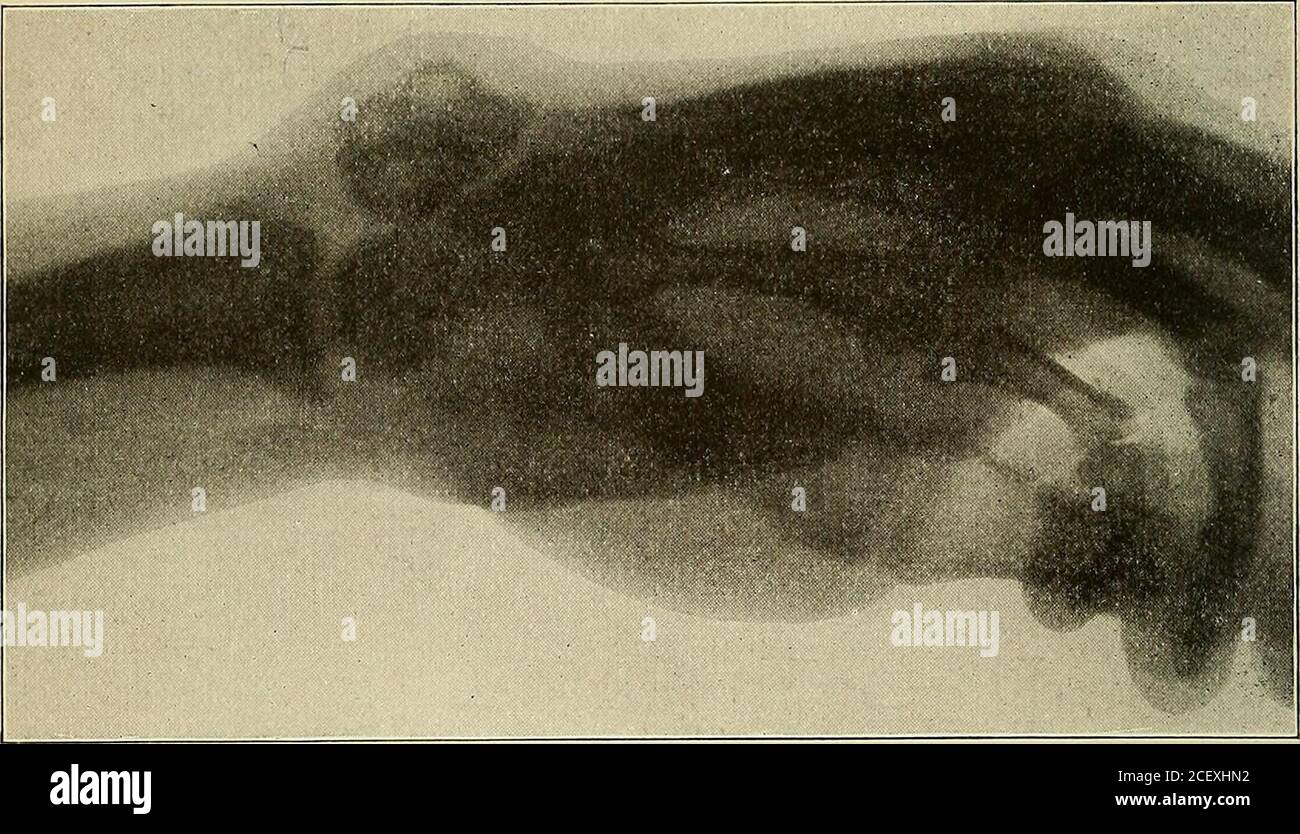 . A practical treatise on fractures and dislocations. Dislocation of ...