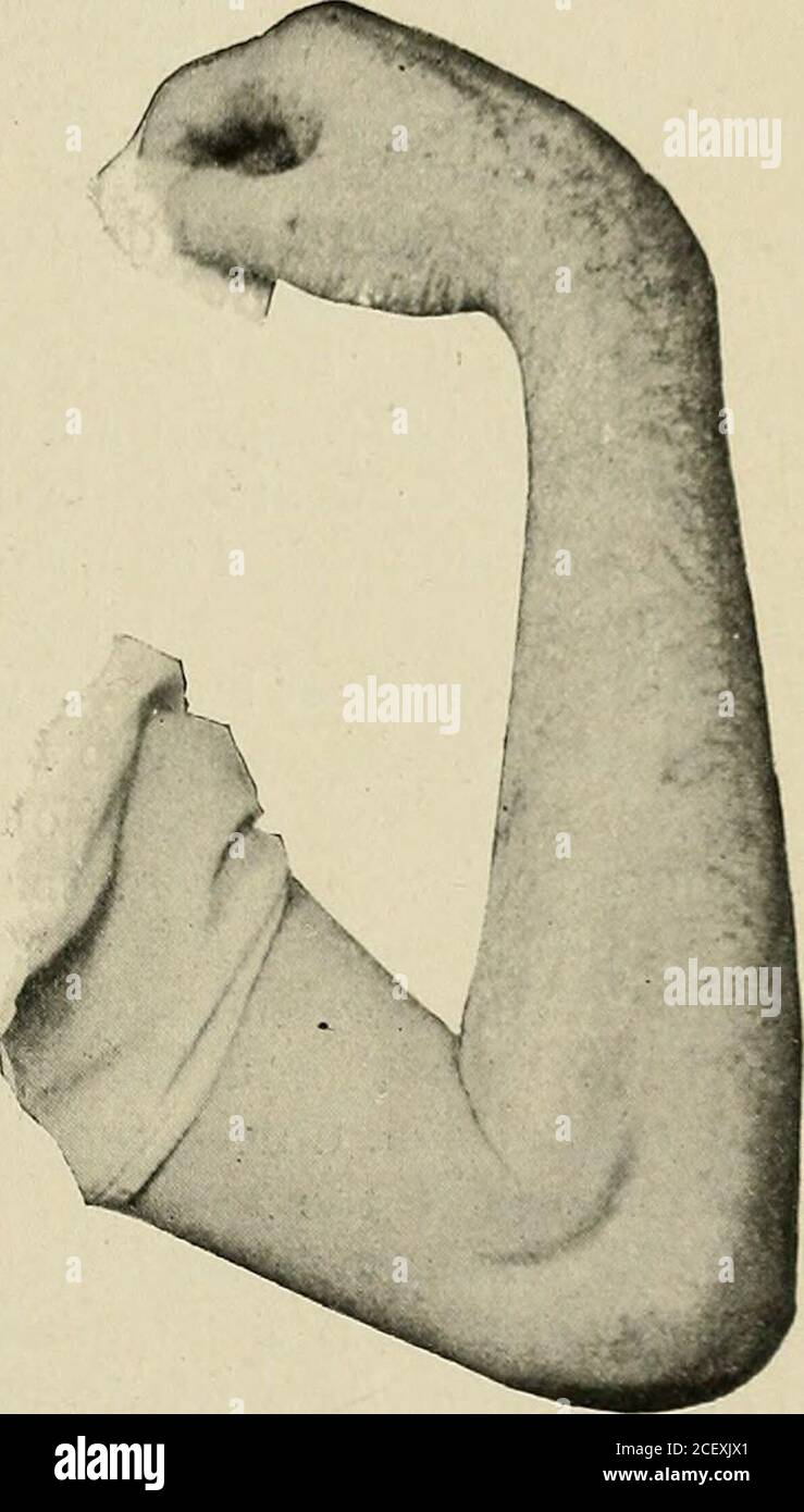. A practical treatise on fractures and dislocations. New formation of ...
