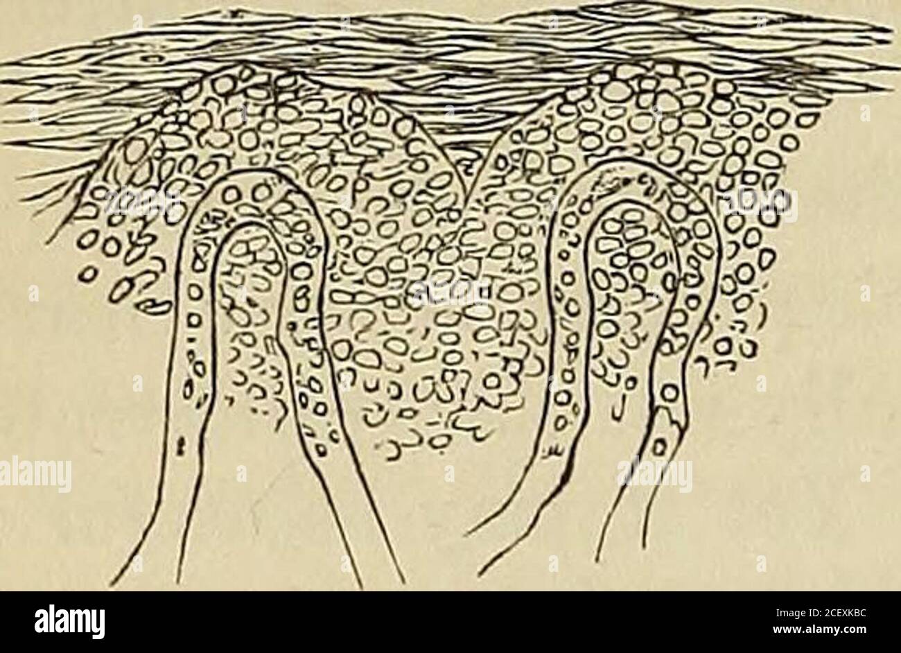 Surgical wound swelling hi-res stock photography and images - Alamy