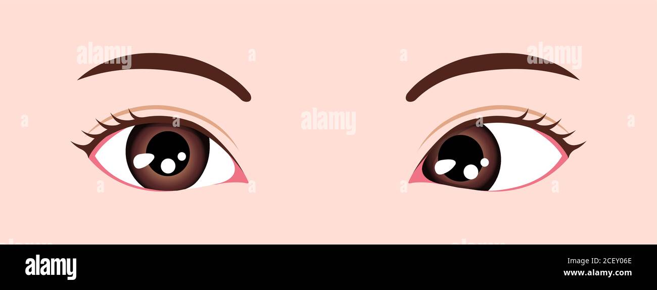 Type of strabismus vector illustration / Esotropia Stock Vector Image ...