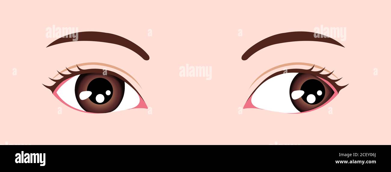 Type of strabismus vector illustration / Exotropia Stock Vector Image ...