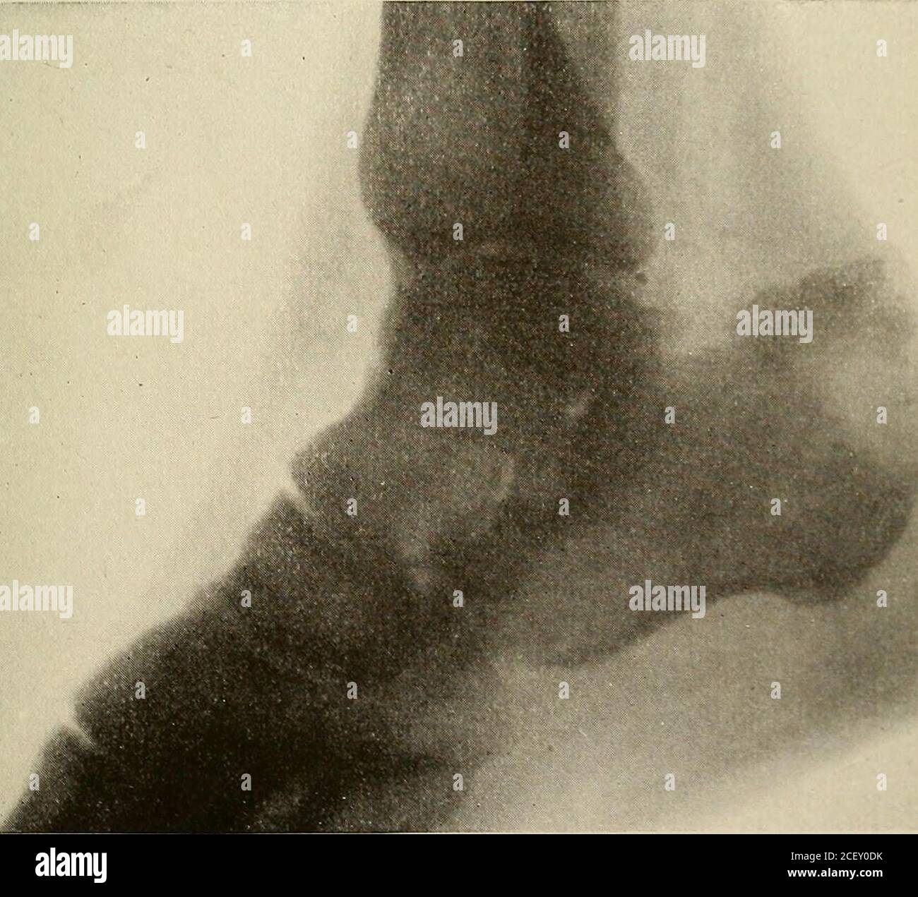 Necrosis foot hi-res stock photography and images - Alamy