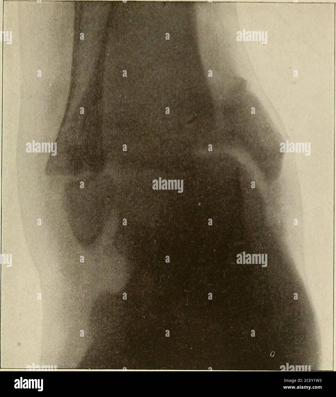. A practical treatise on fractures and dislocations. Longitudinal ...