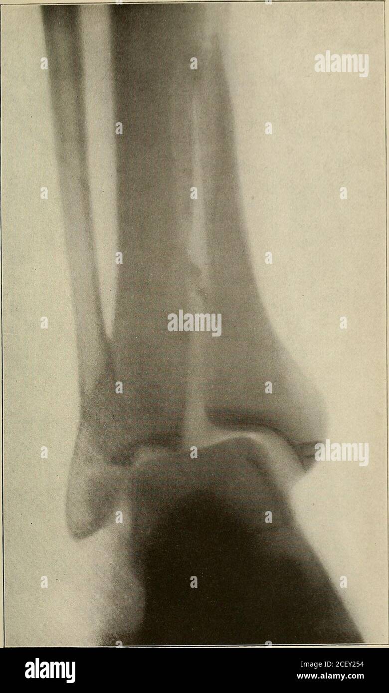 . A practical treatise on fractures and dislocations. Fracture by ...