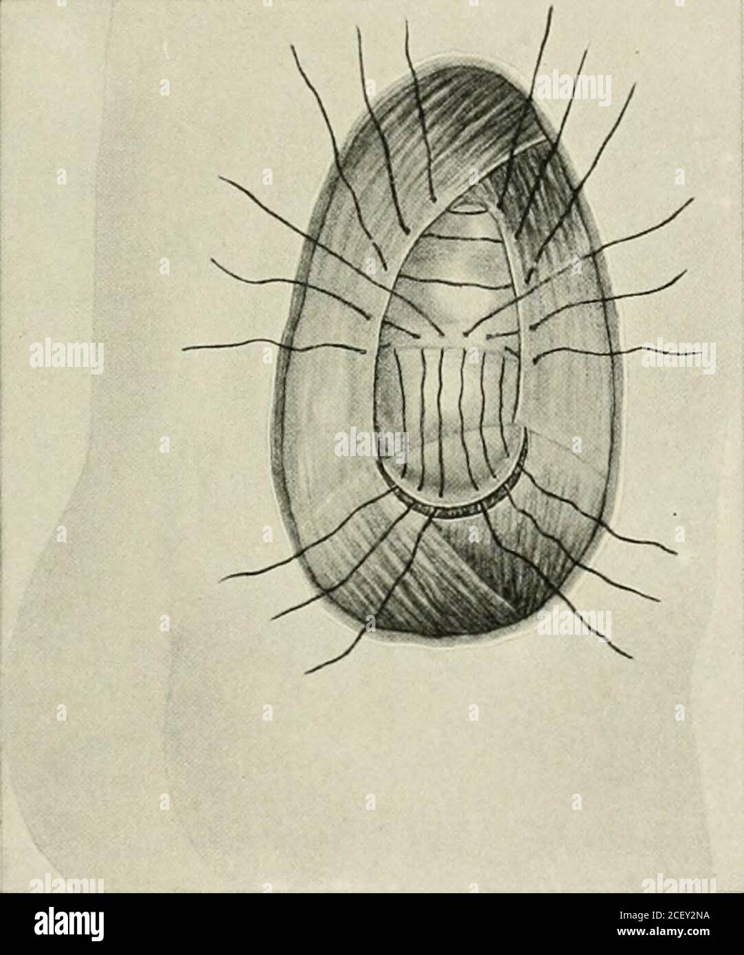 Transversalis Fascia Defects