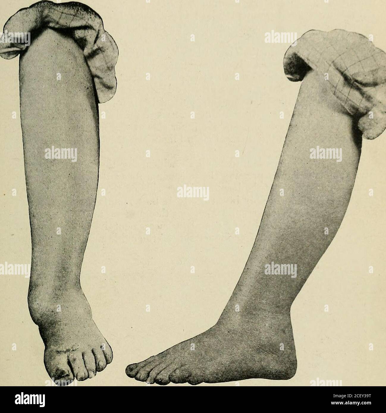. A practical treatise on fractures and dislocations. Potts fracture ...