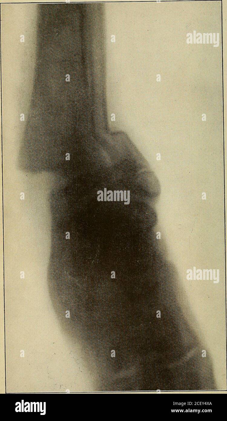 . A practical treatise on fractures and dislocations. Supramalleolar ...