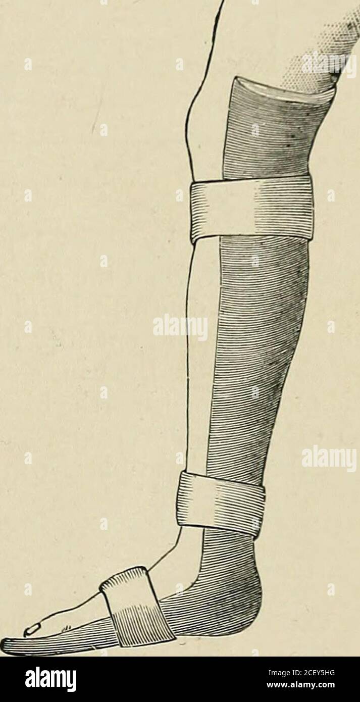 . A practical treatise on fractures and dislocations. Bivalve or ...