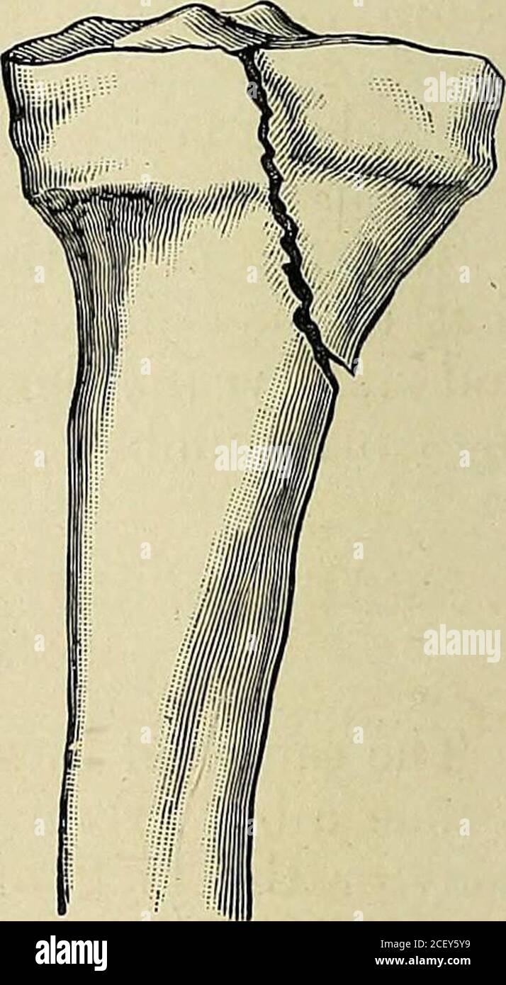 . A practical treatise on fractures and dislocations. Fracture of the ...