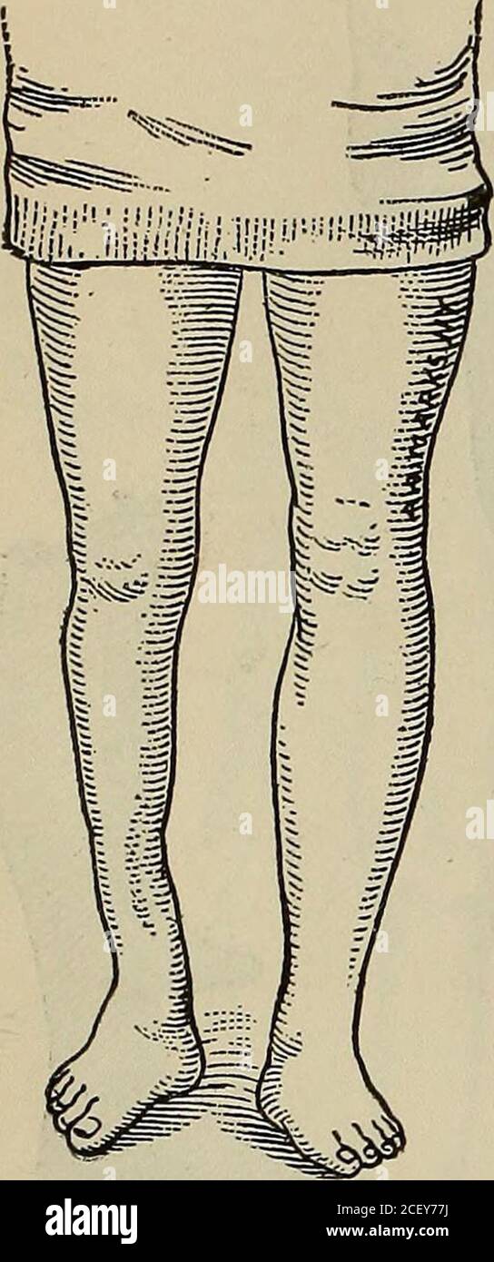 . A treatise on artificial limbs with rubber hands and feet ... walk ...